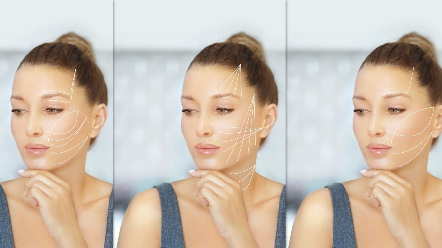 Dermal Thread Lifts - Transfigure Aesthetics